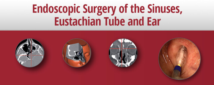 Endoscopic Surgery of the Sinuses, Eustachian Tube and Ear 2021 – Agri ...